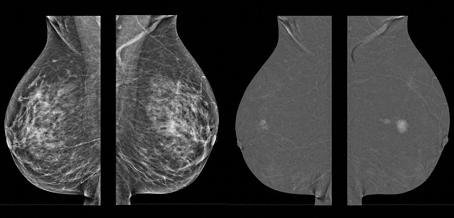 Mammogram test in varanasi What It Is, Purpose, Procedure, Results ...
